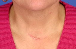 Hyperplastische Narben und Keloide | SpringerLink