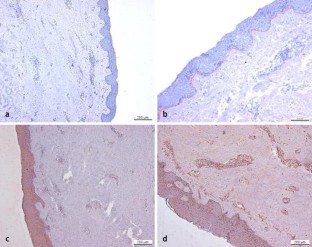 Hyperplastische Narben und Keloide | SpringerLink