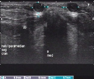 Sonographische Differenzialdiagnose von Raumforderungen der ...