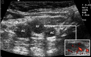 Sonographische Differenzialdiagnose von Raumforderungen der ...