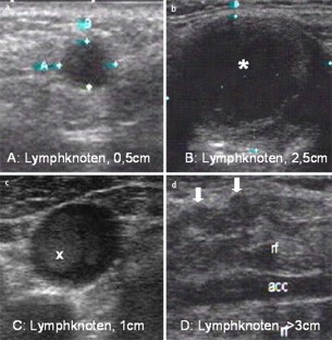Sonographische Differenzialdiagnose von Raumforderungen der ...
