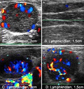 Sonographische Differenzialdiagnose von Raumforderungen der ...