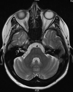 Hyperostose des Meatus acusticus internus | SpringerLink
