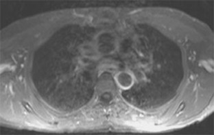 Polymyalgia rheumatica | SpringerLink