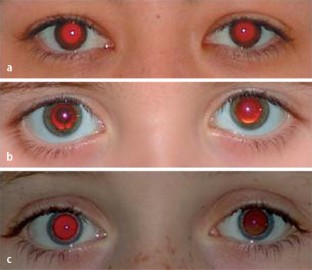 Amblyopie | SpringerLink