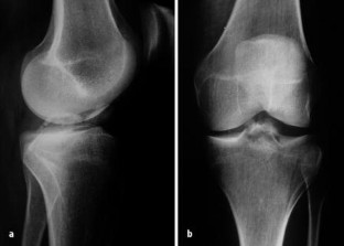 Arthroskopisch gestützte Refixation von Ausrissen der Eminentia ...