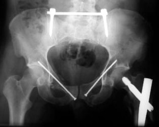 Die minimal-invasive Stabilisierung des dorsalen Beckenrings mit dem ...