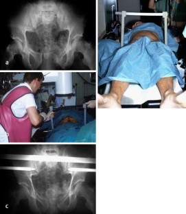 Operative Versorgungsstrategien beim Polytrauma mit Beckenfraktur ...