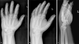 Frakturen des Handgelenks und der Hand | SpringerLink