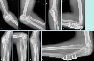 Luxationsfrakturen des Unterarms | SpringerLink