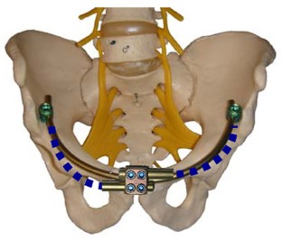 Der subkutane ventrale Fixateur interne (SVFI) am Becken | SpringerLink