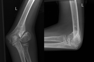 Pseudarthrose des kindlichen Condylus radialis humeri mit ...