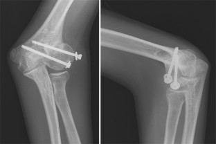 Pseudarthrose des kindlichen Condylus radialis humeri mit ...