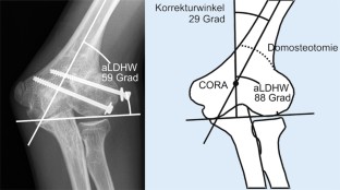 Pseudarthrose des kindlichen Condylus radialis humeri mit ...