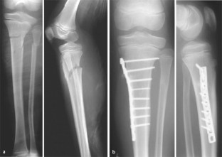 Frakturen der proximalen Tibia | SpringerLink