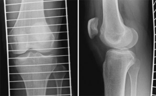 Patellaluxation | SpringerLink