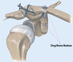 Arthroskopisch gestützte Techniken zur Versorgung der akuten und ...