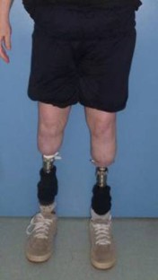 Endo-Exo-Prothesen | SpringerLink