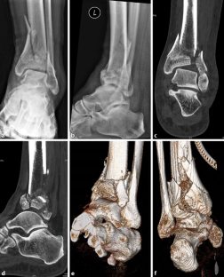 Frakturen des Pilon tibiale | SpringerLink