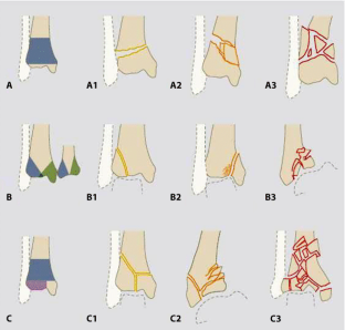 Frakturen des Pilon tibiale | SpringerLink