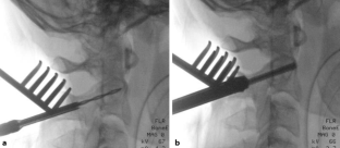 Dorsale atlantoaxiale Stabilisierung in Goel-Harms-Technik | SpringerLink