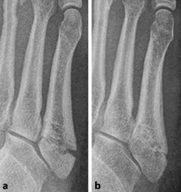 Frakturen der Metatarsale Fünf Basis – eine Neubetrachtung | SpringerLink