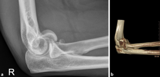 Konkomitante Fraktur des Capitulum humeri und des Caput radii ...