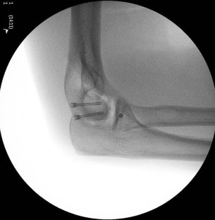 Konkomitante Fraktur des Capitulum humeri und des Caput radii ...