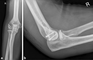Konkomitante Fraktur des Capitulum humeri und des Caput radii ...