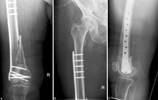 Distale Femurfrakturen | SpringerLink