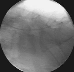 Lumbale adhäsive Arachnoiditis | SpringerLink