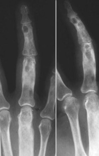 Tumorähnliche Knochenläsionen | SpringerLink