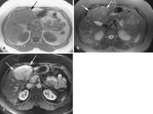 MRT der Leber | SpringerLink