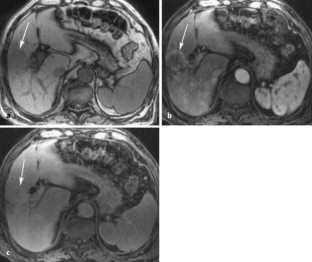 MRT der Leber | SpringerLink