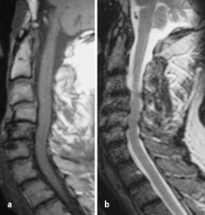 Stellenwert von Myelographie, Myelo-CT und MRT in der Diagnostik der ...