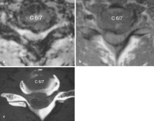 Stellenwert von Myelographie, Myelo-CT und MRT in der Diagnostik der ...