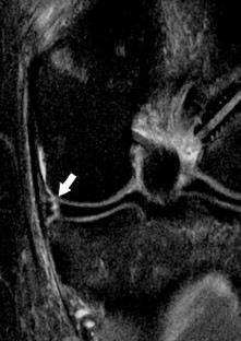 MRT des Kniegelenks | SpringerLink