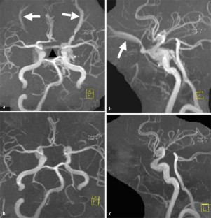 Neuroradiologische Diagnostik und interventionelle Therapie bei Carotis ...