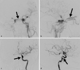Neuroradiologische Diagnostik und interventionelle Therapie bei Carotis ...
