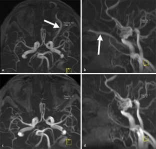 Neuroradiologische Diagnostik und interventionelle Therapie bei Carotis ...