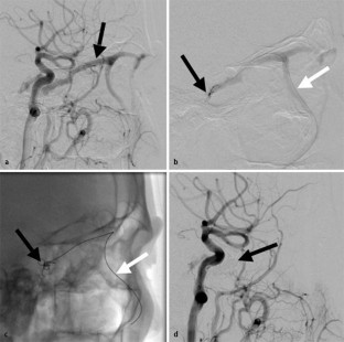 Neuroradiologische Diagnostik und interventionelle Therapie bei Carotis ...
