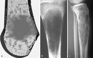 Basisdiagnostik von Knochentumoren | Die Radiologie
