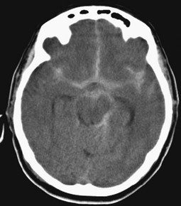 Bildgebende Diagnostik der Subarachnoidalblutung | SpringerLink