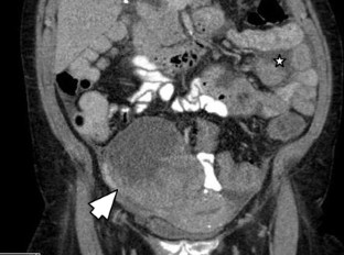 Radiologische Diagnostik des Ovarialkarzinoms | SpringerLink