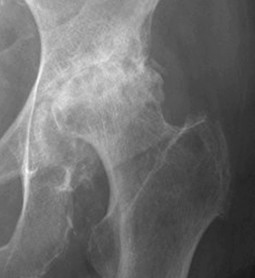 Koxarthrose – eine radiologische Annäherung und Leitfaden | SpringerLink