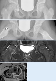 Koxarthrose – eine radiologische Annäherung und Leitfaden | SpringerLink
