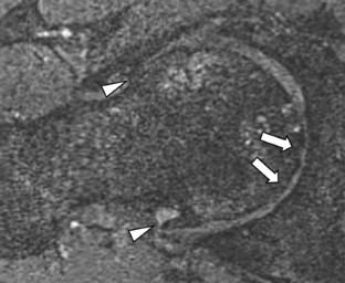 Koxarthrose – eine radiologische Annäherung und Leitfaden | SpringerLink