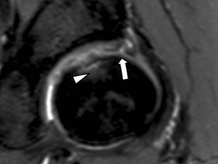 Koxarthrose – eine radiologische Annäherung und Leitfaden | SpringerLink