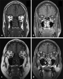 Diagnose und Differenzialdiagnose der endokrinen Orbitopathie in der ...