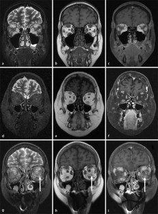 Diagnose und Differenzialdiagnose der endokrinen Orbitopathie in der ...
